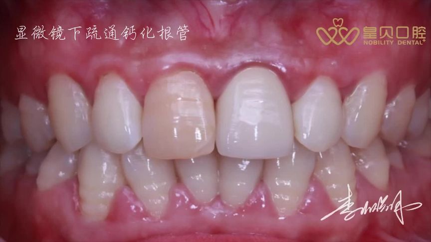 #牙齿健康 显微镜下疏通钙化根管