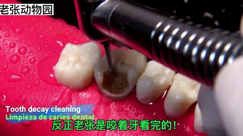 给牙齿做根管治疗