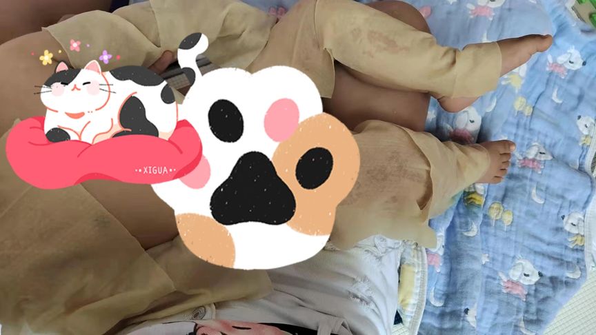 宝宝干性湿疹反反复复,医院拿中药回来泡澡,妈妈的做法太狠心了