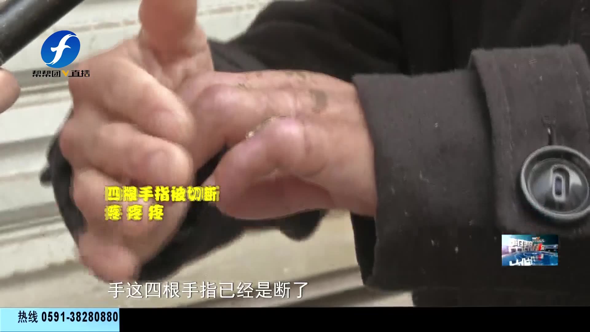 【第一帮帮团】木工意外切断四根手指,赔偿金额协商不下,雇主该付...