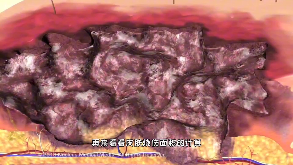 烧伤后你的皮肤发生了什么,烧伤的治疗,3D演示。