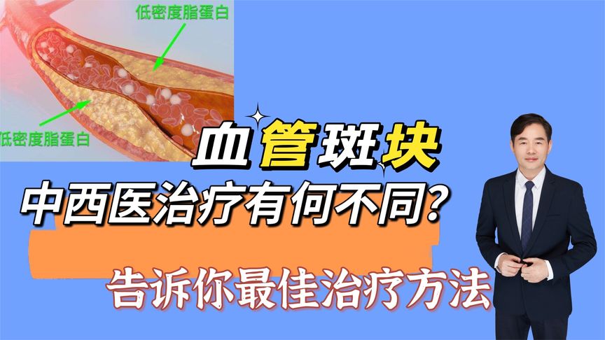 血管斑块,中西医治疗有啥不同?怎样治疗效果好?告诉你方法