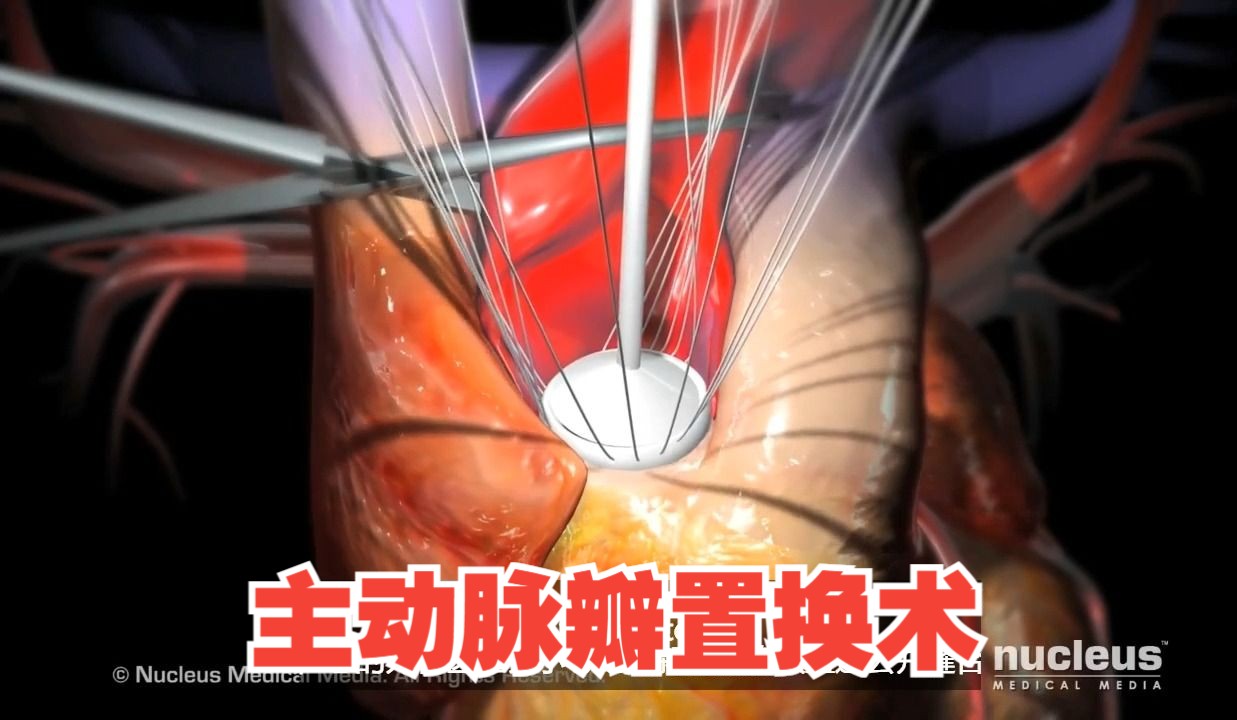 【3D医学动画】主动脉瓣置换术