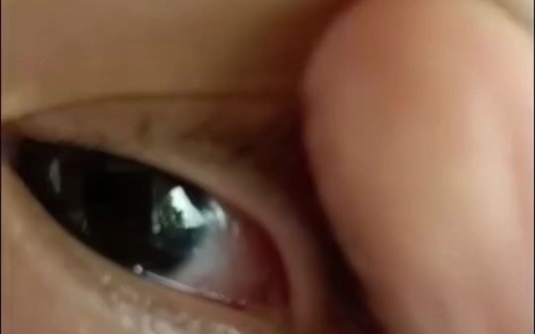 男童眼里捉出6条蠕动活虫,和接触宠物有关?