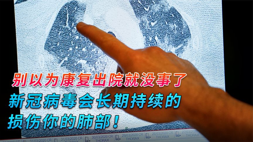 别以为康复出院就没事了,新冠病毒会长期持续的损伤你的肺部!