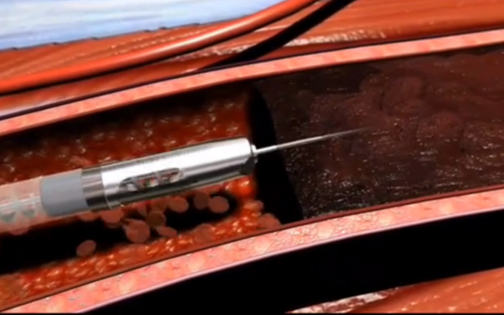 3D视频演示:动脉粥硬化血栓切除术