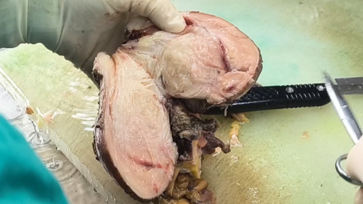 ...症!由于女性特殊的生理解剖特点,直肠病变时和子宫有时候会发生粘连!