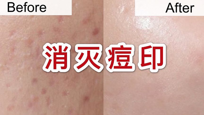 干货!4分钟教你消除痘印痘坑,快速恢复光滑肌