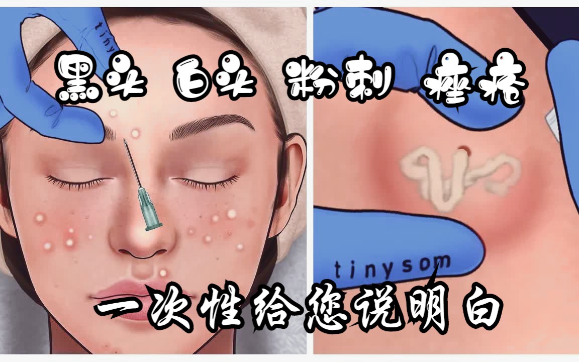 痤疮、青春痘、黑头、白头,一次性给您说明白