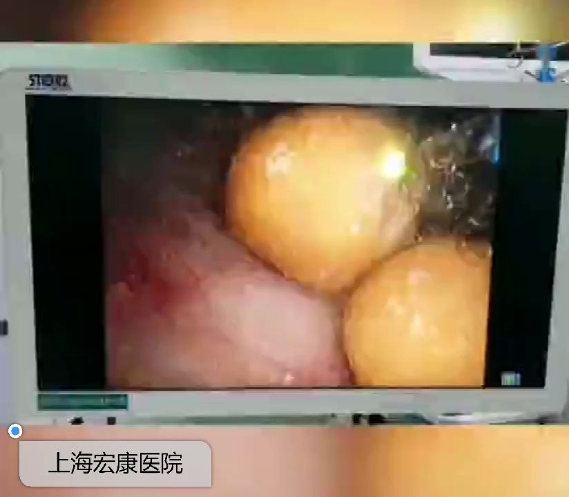 结石体内激光碎石_激光打碎结石视频