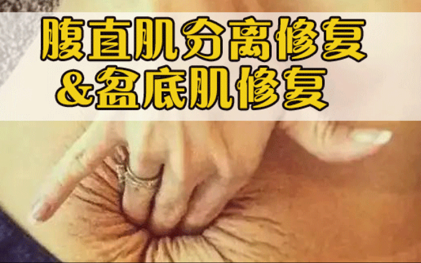 10万私教也不舍得告诉你的腹直肌分离修复和盆底肌修复的干货!值得...