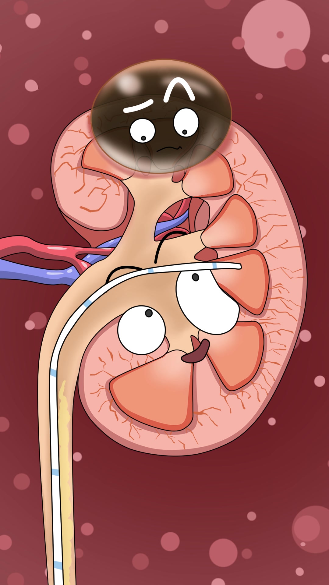 腹腔镜肾囊肿手术
