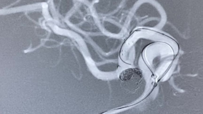 微导管穿越Y型支架网眼,进入动脉瘤残腔死角#神经介入 #医学影像