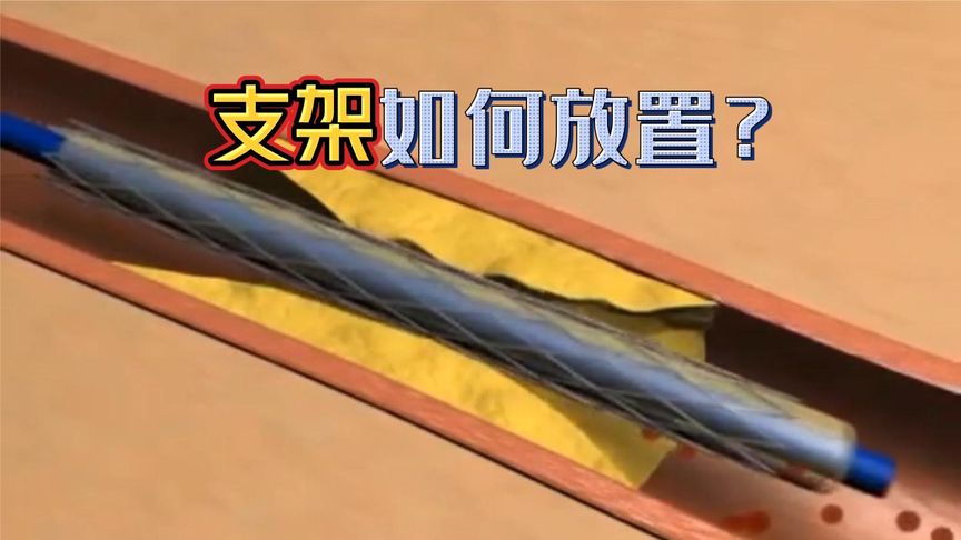 了解#支架置入过程 避免#血管狭窄