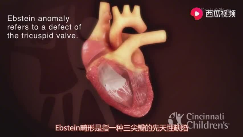 ...失常,以前常用房化右室折叠加三尖瓣成形,现在大孩子流行锥形手术