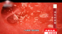 血在人体中有什么作用?如何血管出了问题会导致什么情况出现?