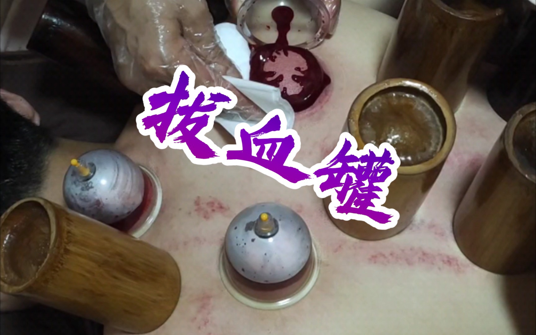 『中医理疗拔血罐』(你从未有过的全新体验)
