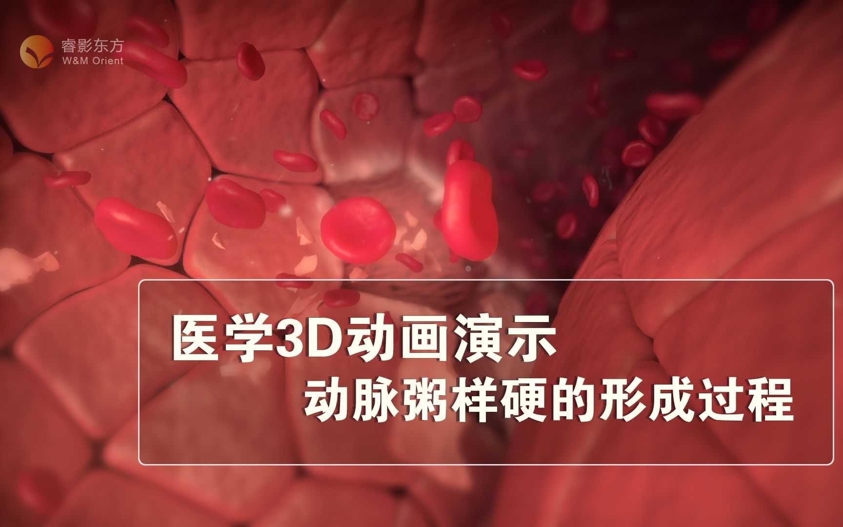 医学3D动画演示,动脉粥样硬化与心肌梗死