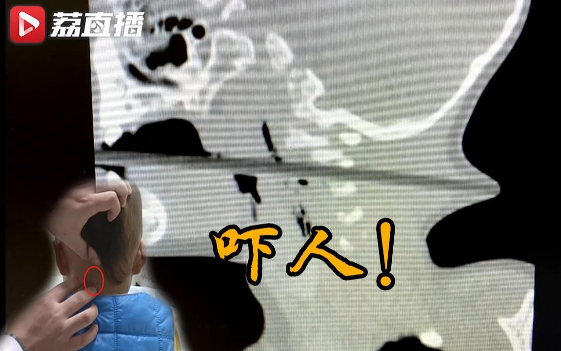 苹果插在筷子上吃,2岁宝宝被筷子戳穿喉咙!