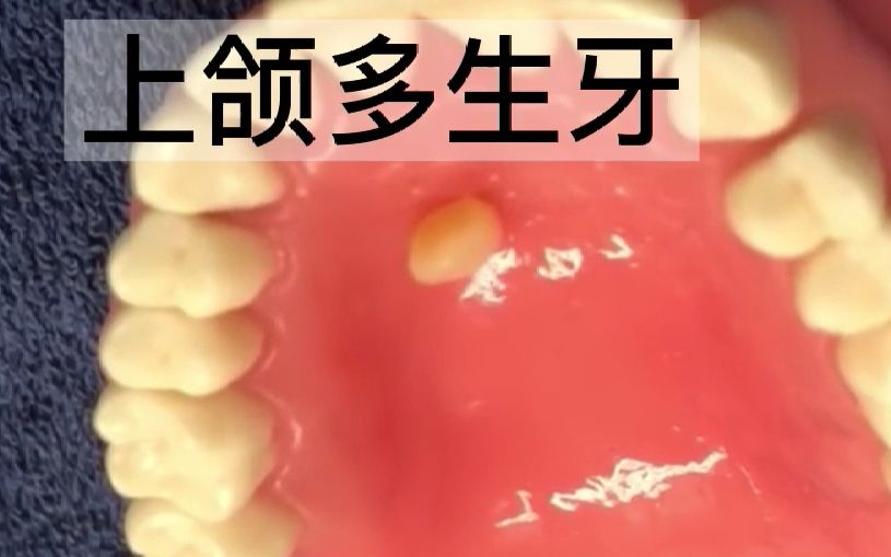 你长过多生牙吗?模拟多生牙拔除过程(非真实案例)