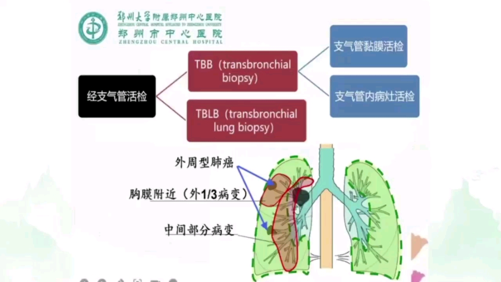 【支气管镜入门4】支气管镜肺活检