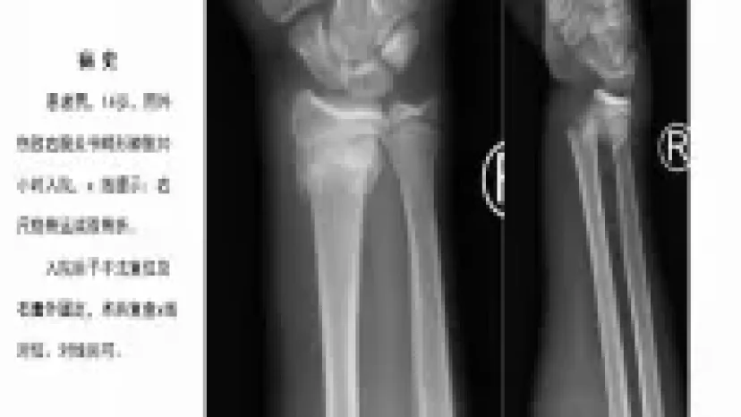 赣南正骨 手法复位-尺桡骨远端双骨折