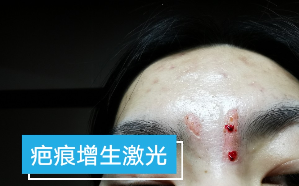 激光去除增生疤痕的全部细节 价格 以及痤疮的后期表现