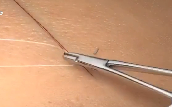 超酷医学视频: 皮肤缝合动画演示