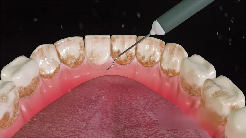 牙医使用超声波振动器模拟牙垢清洁过程!