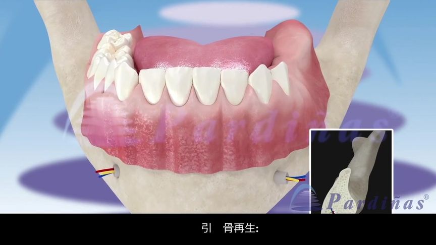 3D牙科治疗动画21.引导骨再生