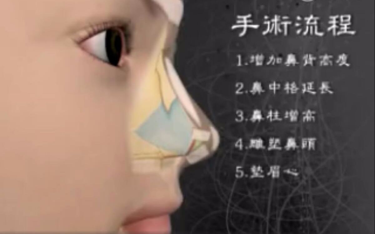自体软骨鼻综合全手术过程,打算做鼻子的仙女可以仔细看看～