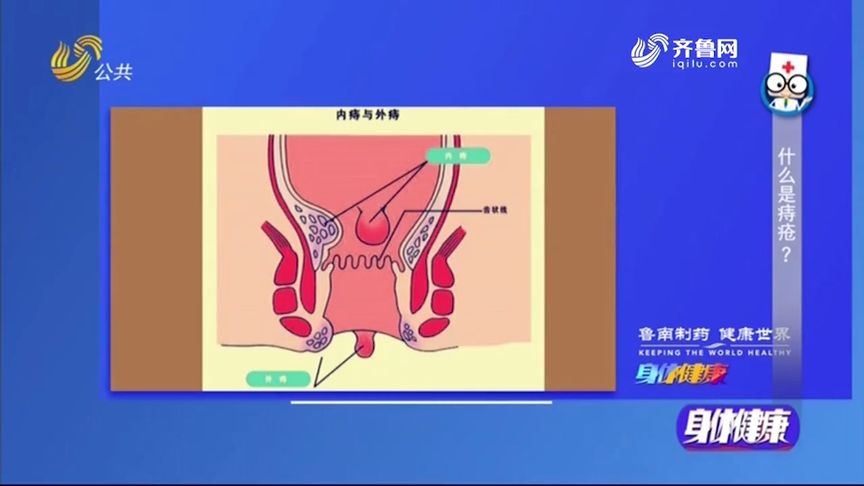 医生把痔疮分为三类,病友们自测一下自己属于哪种类型|身体健康