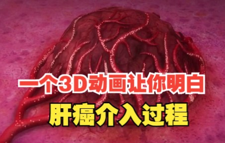 一个3D动画让你明白,肝癌介入