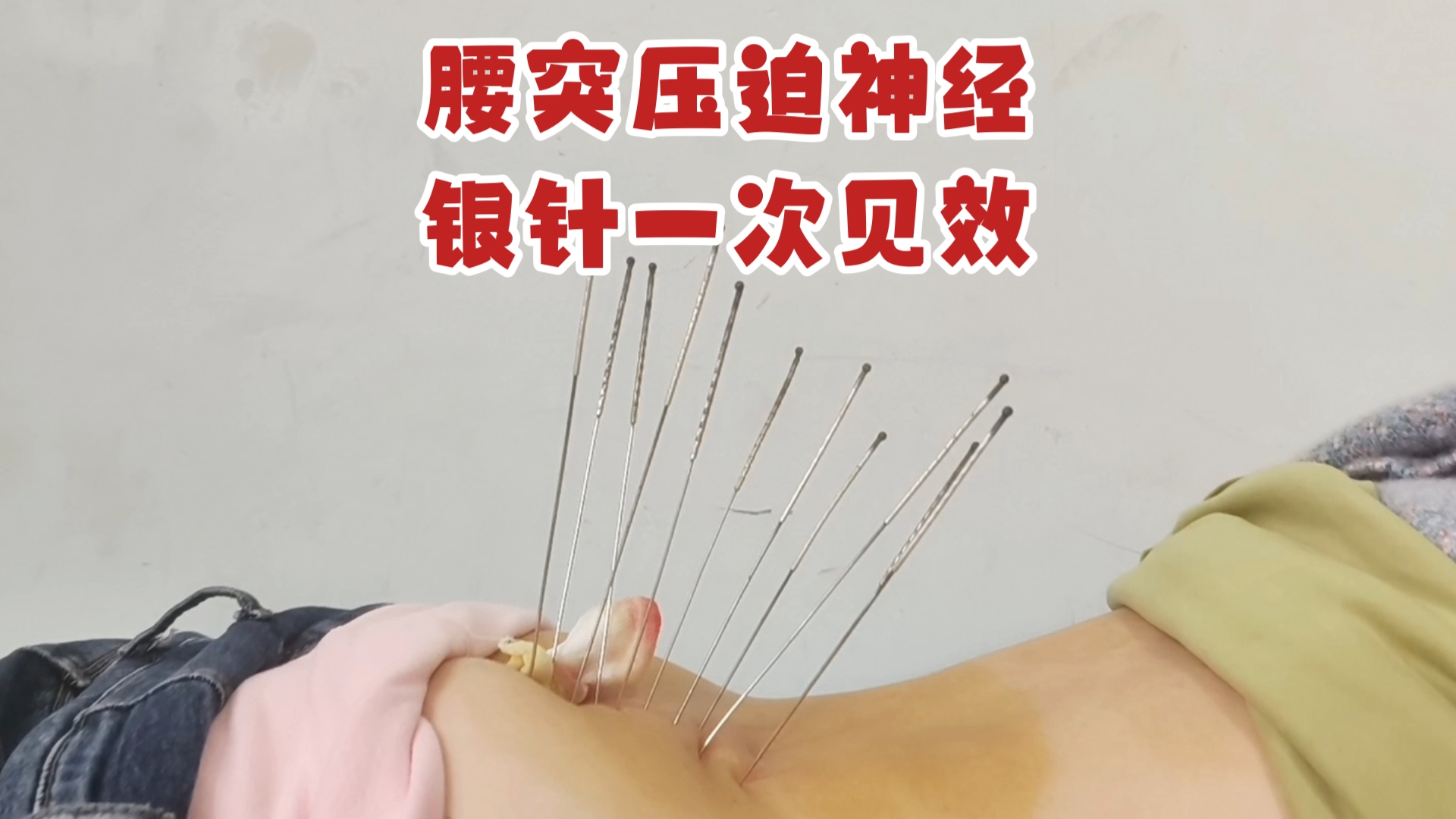 腰酸屁股痛!银针疗法一次见效!
