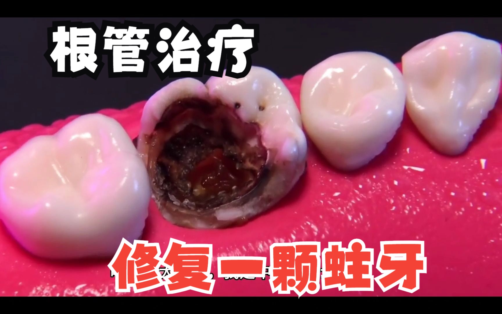 根管治疗修复一颗蛀牙,带你了解牙齿修复过程