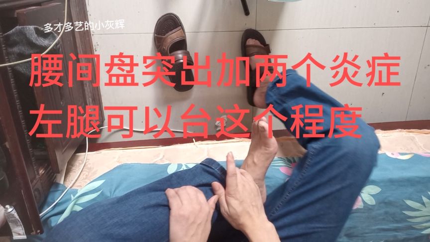 腰间盘突出民间药第34天 拔血罐腰好一点 没坐着腰没有那么僵硬