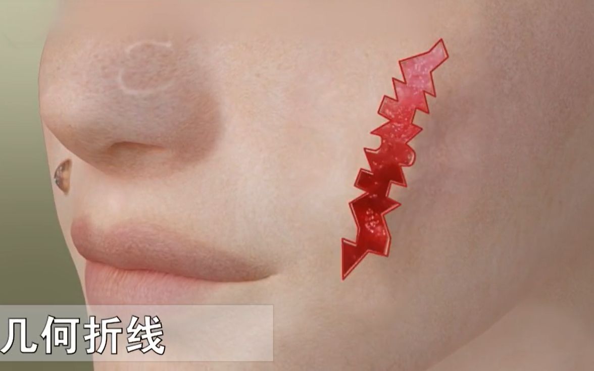 十种去除面部皮肤损伤的缝合方法,真是太考验医生技术了!