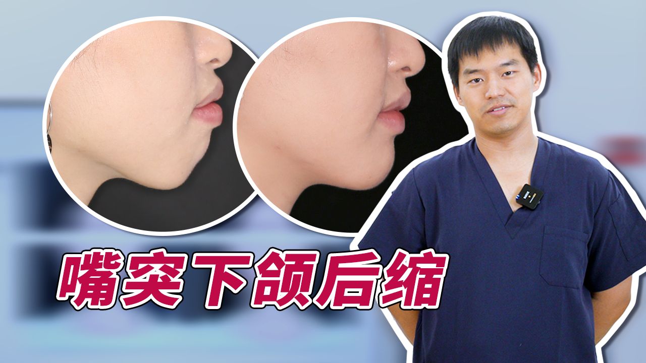 嘴突+下颌后缩?矫正过程中拔牙间隙关闭如何塑造美丽侧貌!