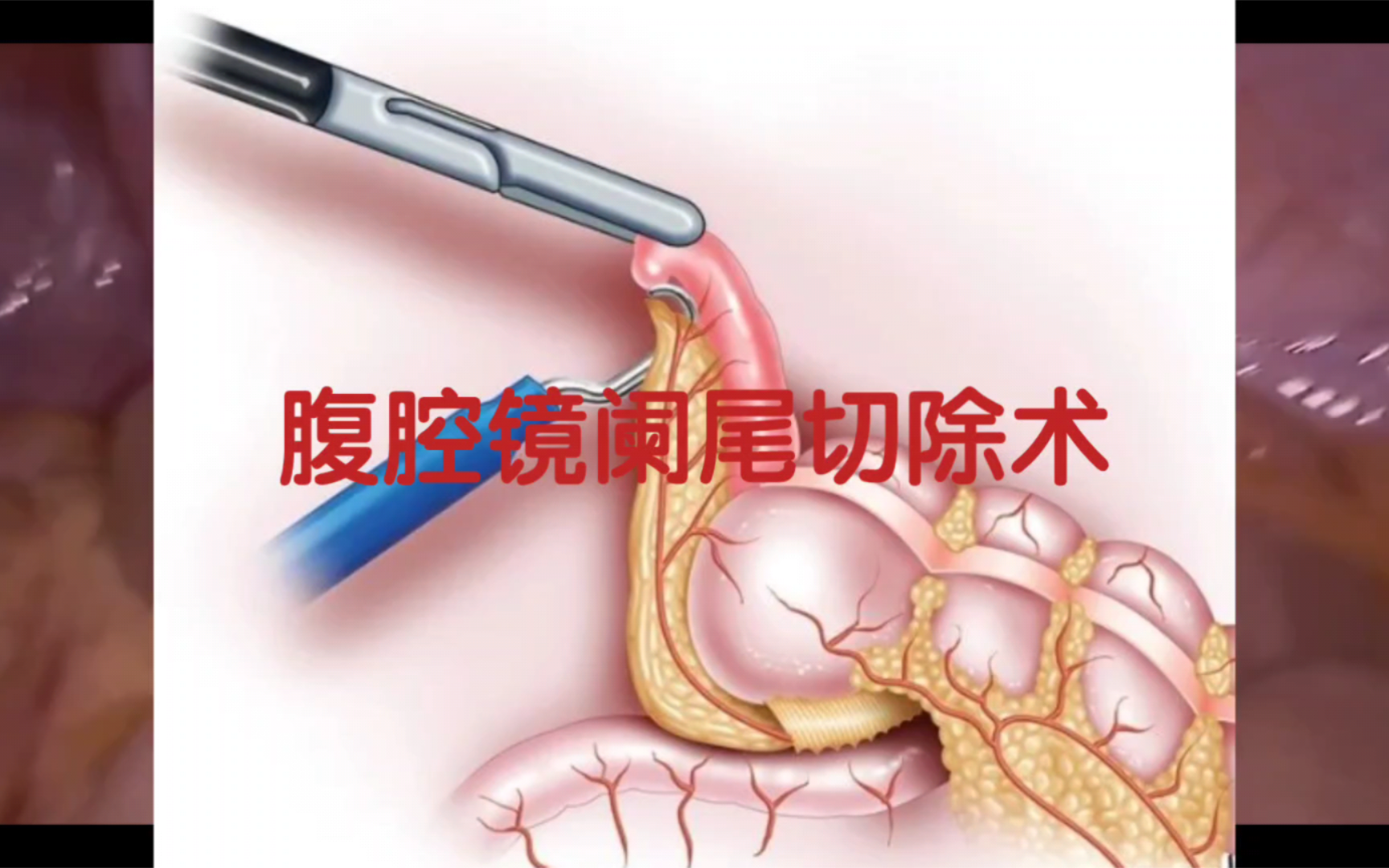 腹腔镜下阑尾切除术