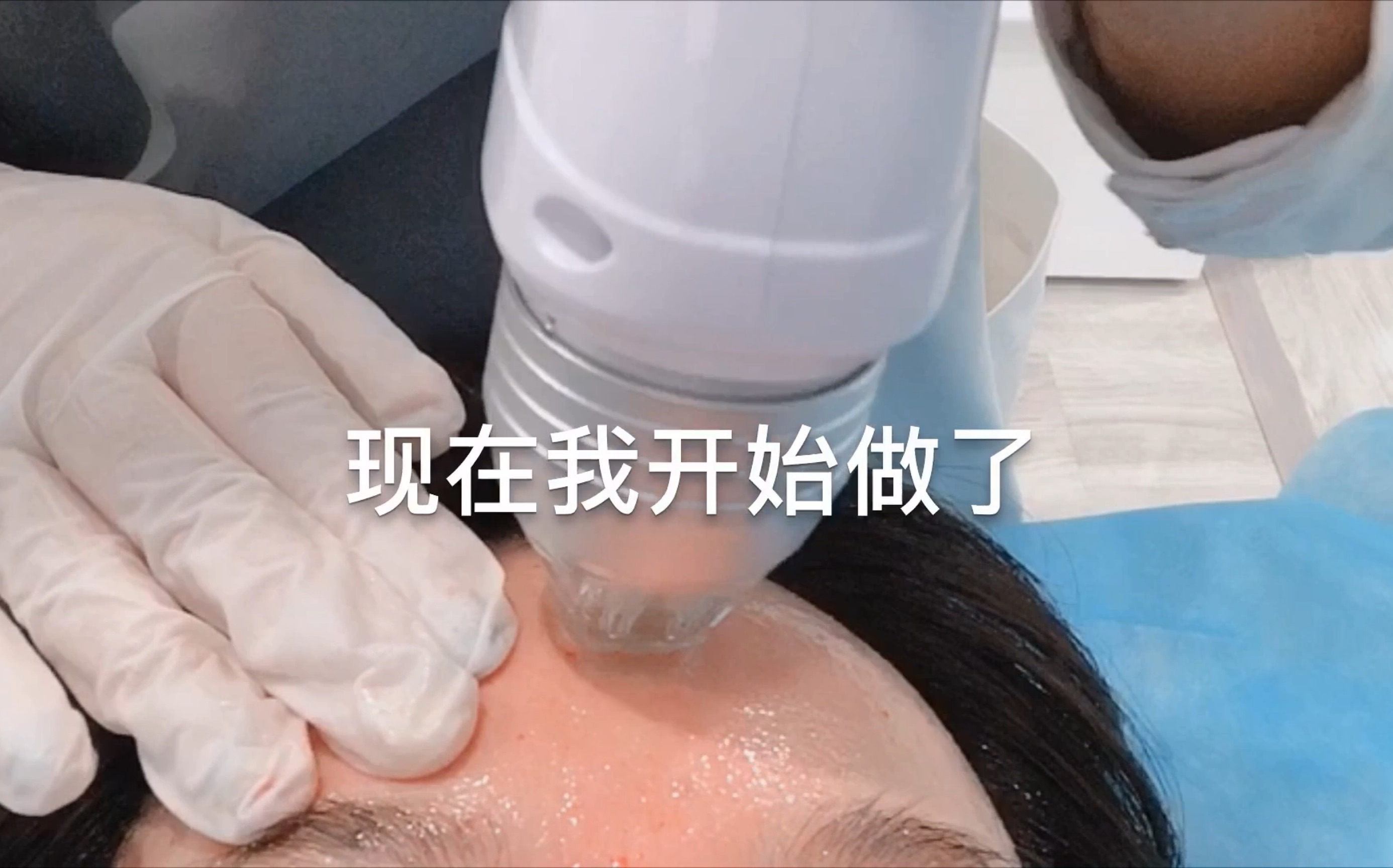 黄金微针射频让我变成灯泡肌