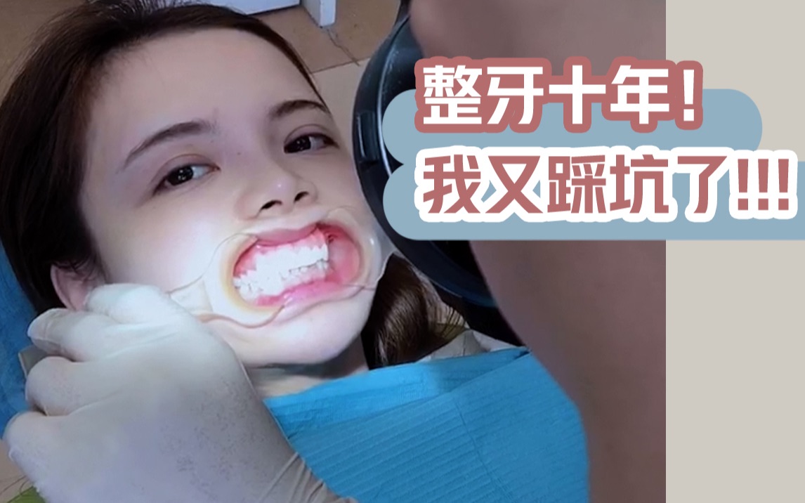 ...选?贴面的副作用?雷让我来踩,你们吸取经验不要走我的老路子就好!