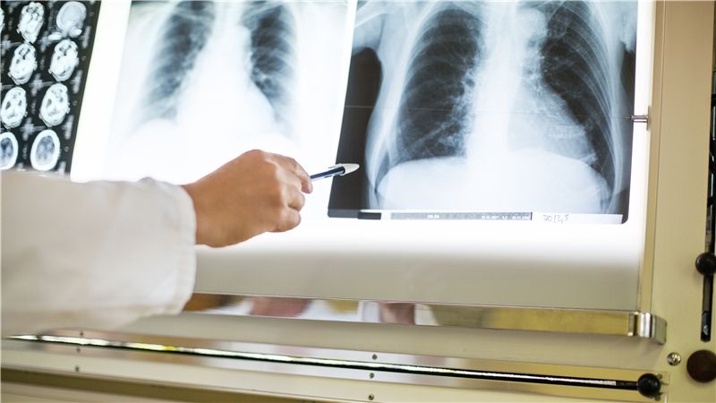 肺CT提示动脉硬化应该怎么办?