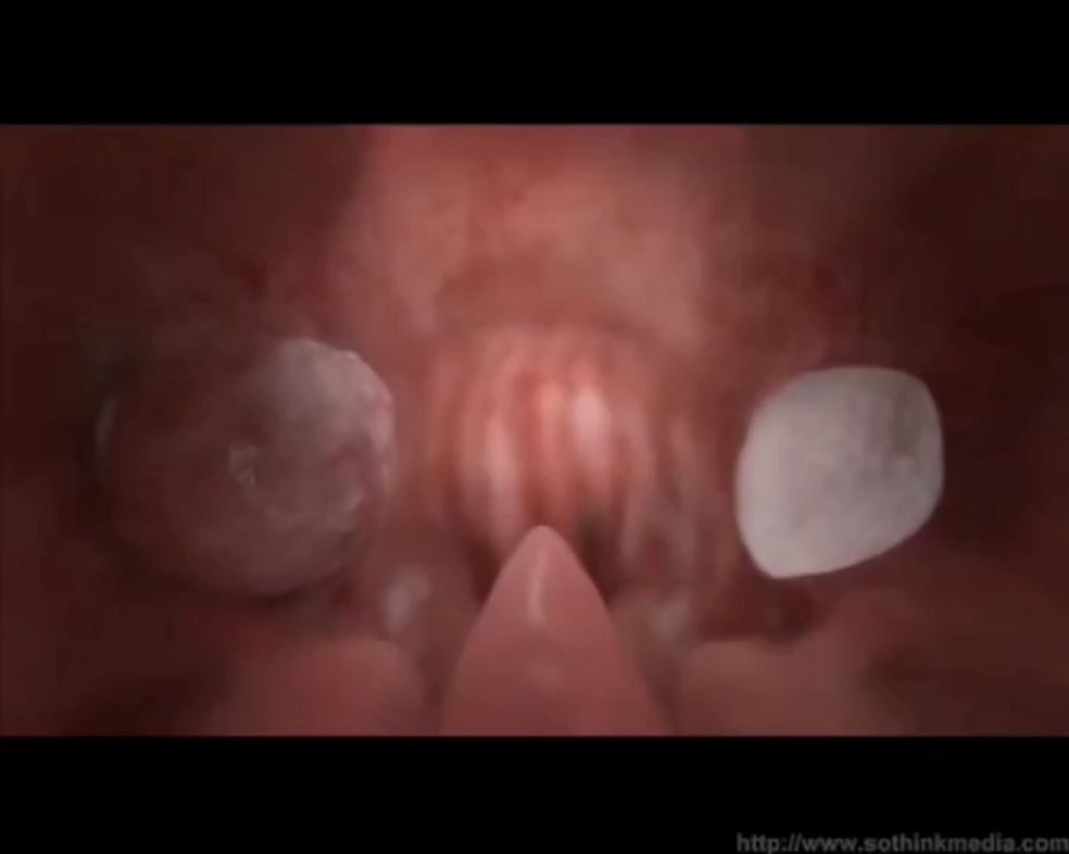 等离子刀切除扁头体和腺样体手术过程,3D演示。