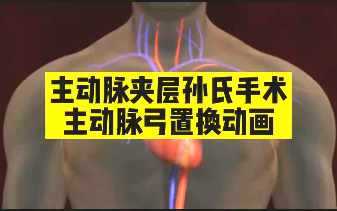 主动脉夹层Stanford A型手术视频动画,主动脉弓置换。难度挺大!