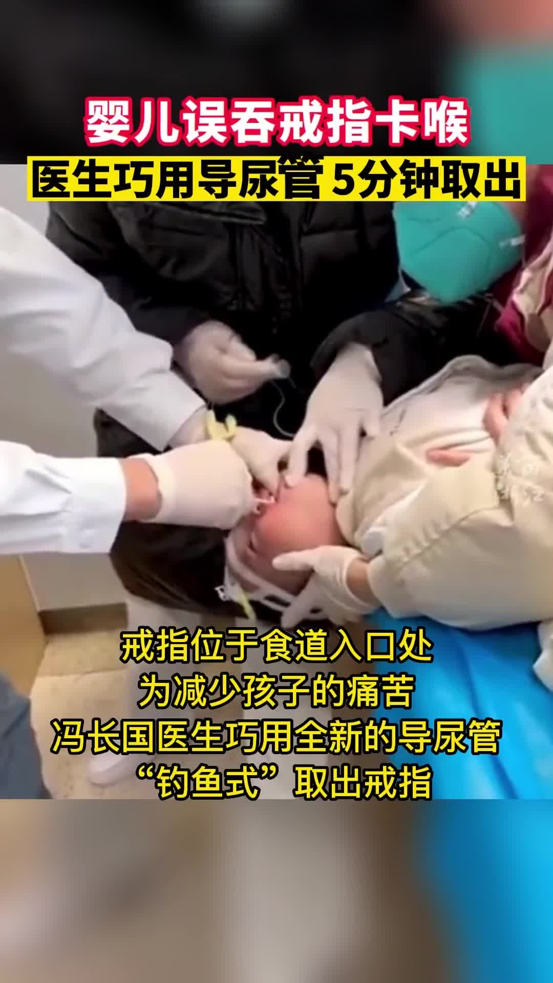 婴儿误吞戒指卡喉,医生巧用导尿管5分钟取出!