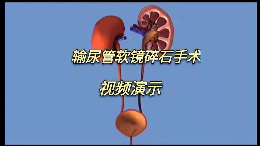 输尿管软镜碎石(视频演示)
