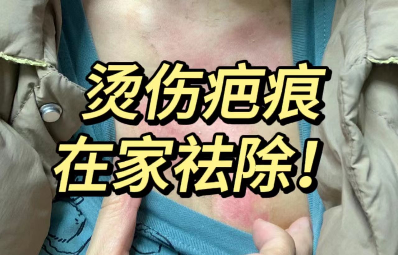 烫伤疤痕增生要怎么修复?