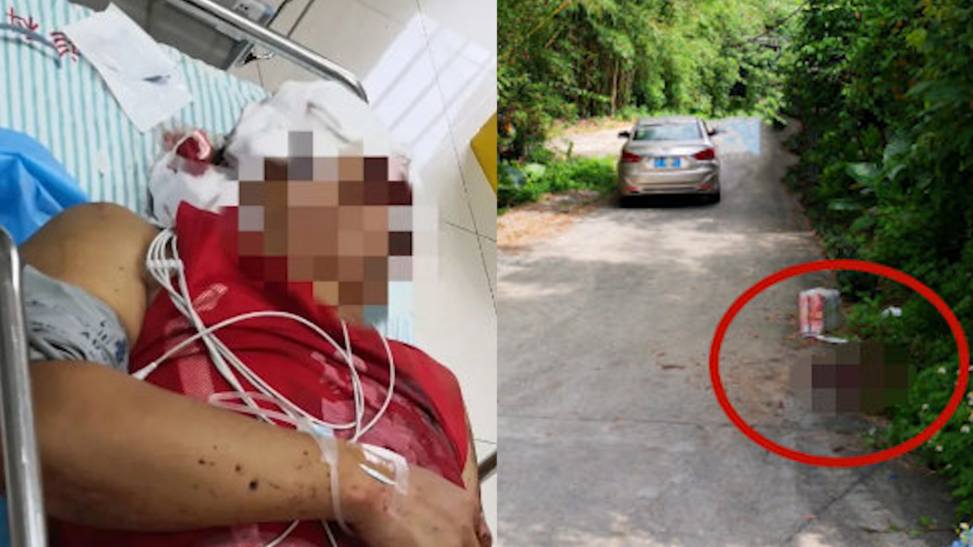 男子躺路上玩手机遭车碾压失去右眼 交警:司机负主要责任