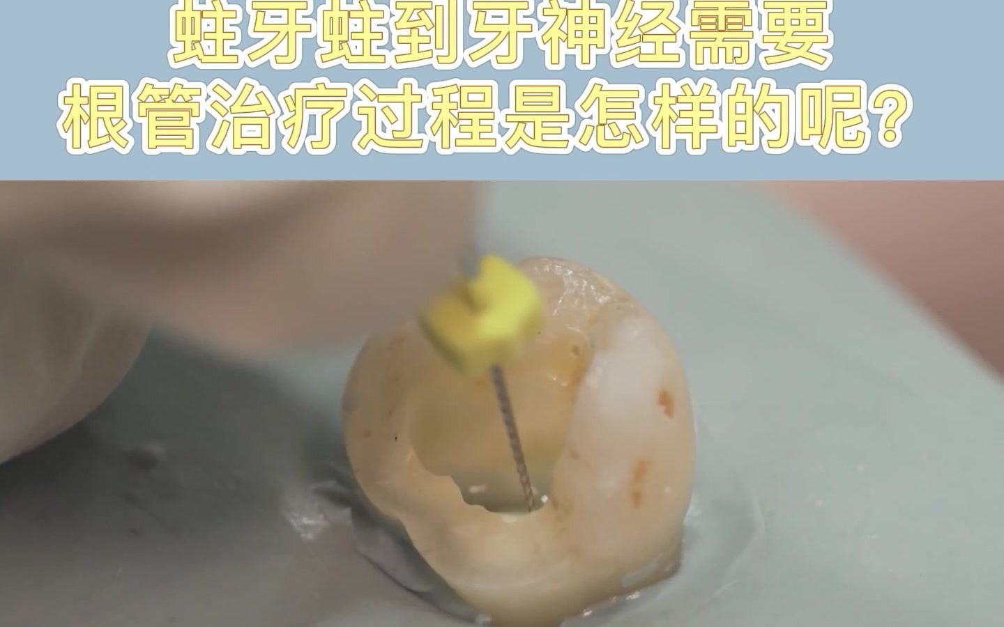 【深圳根管治疗】蛀牙蛀到牙神经需要根管治疗过程是怎样的呢?