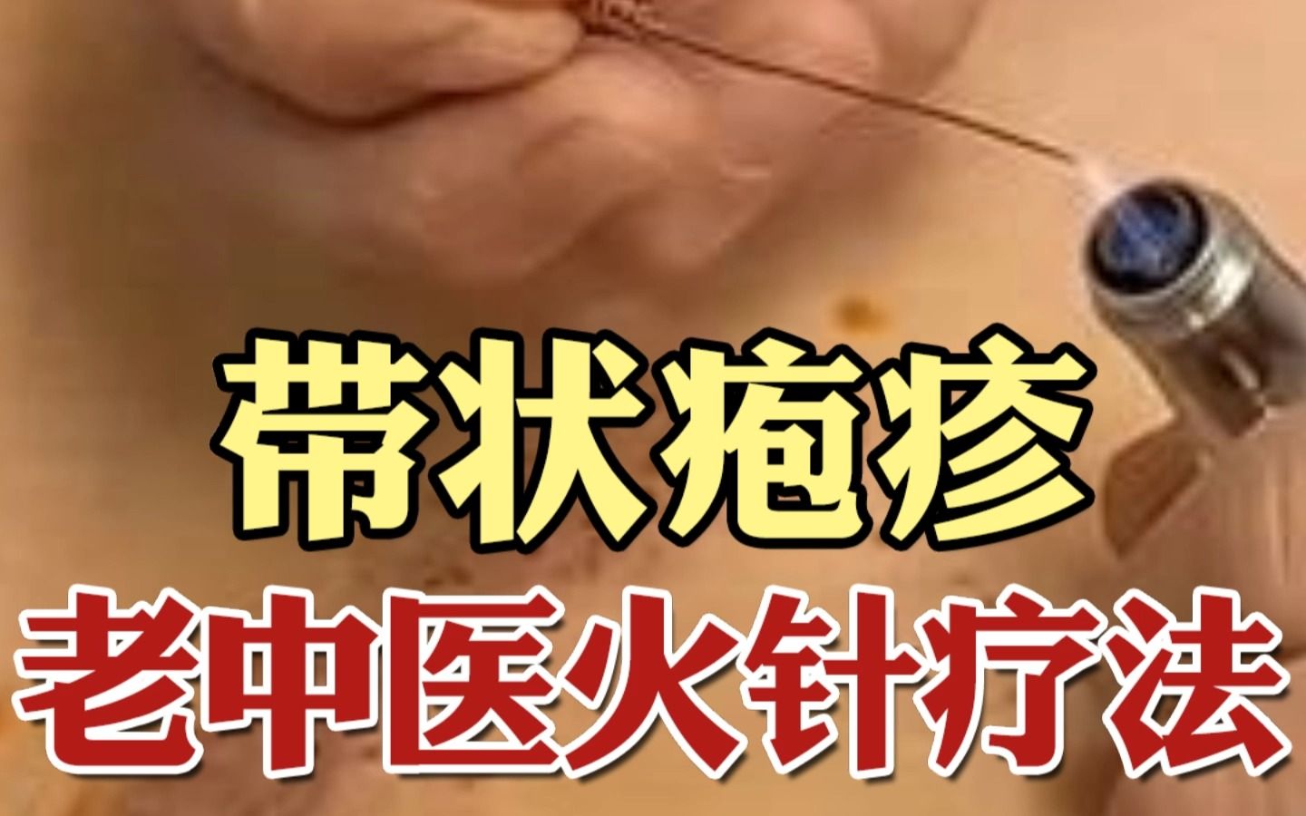 带状疱疹 老中医火针疗法